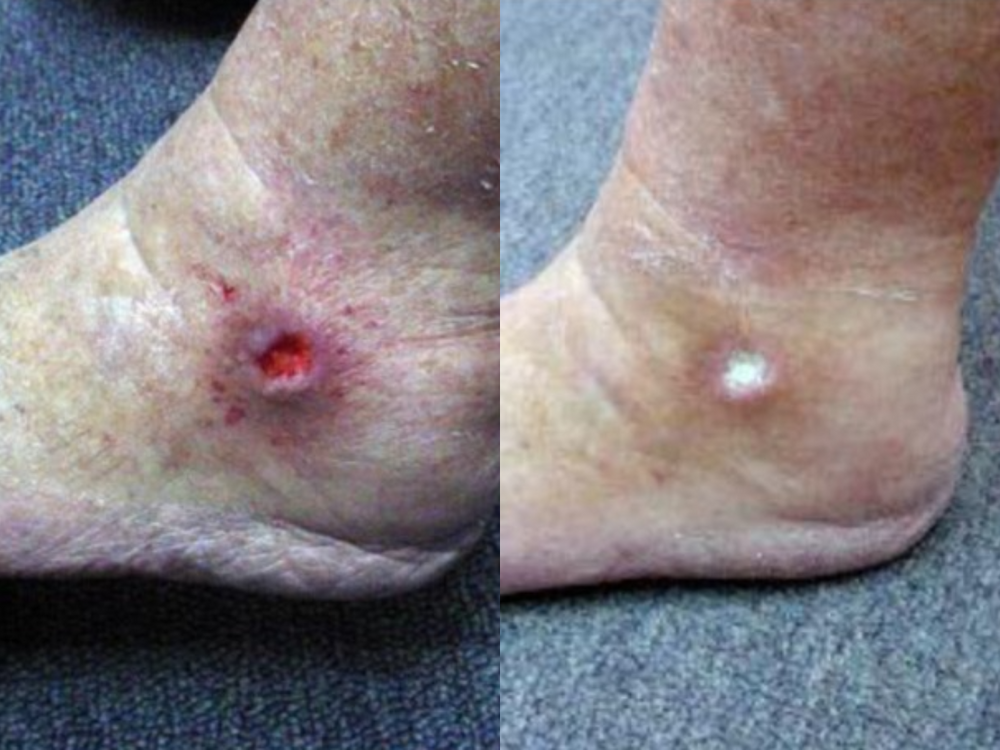 Better and faster wound healing